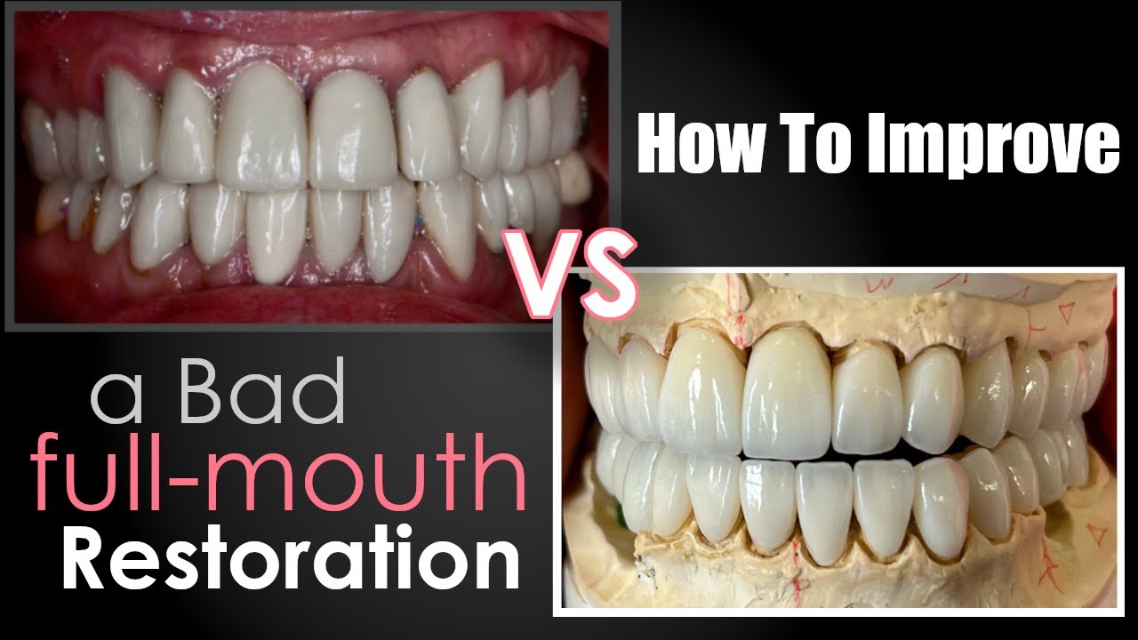 How to Improve a Bad Full-Mouth Restoration – Gentle Nerves Relaxing Sounds